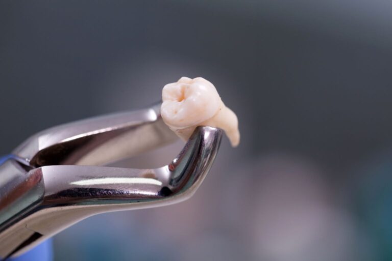 Step-by-Step Guide to Tooth Extraction | Jagare Ridge Dental